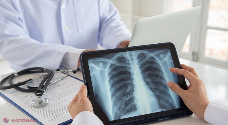 Nouă simptome ale cancerului de plămâni, boala la care fumatul e ...