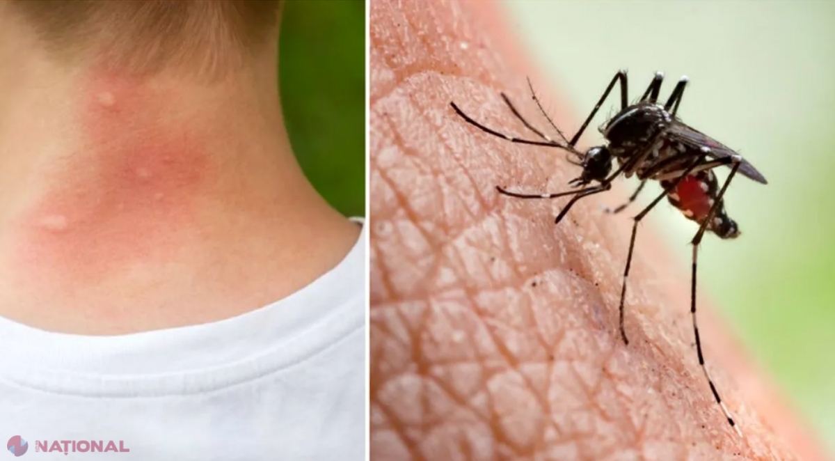 Why Do Mosquitoes Always Bite Me? Exploring the Factors that Attract Mosquitoes - World Today News